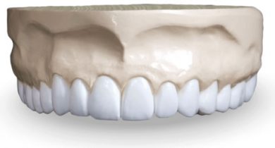 Diagnostic Wax Ups | Artistic Dental Lab